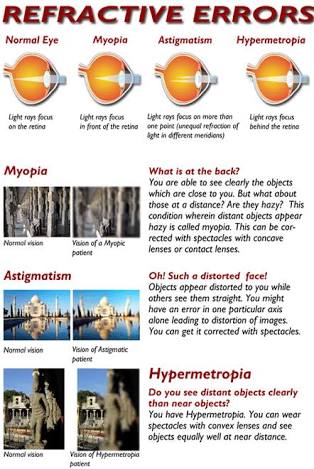 Optometrists: Inside Deviation of the Eye in Childrens