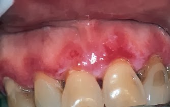 Stomatitis: Types Of Denture Stomatitis