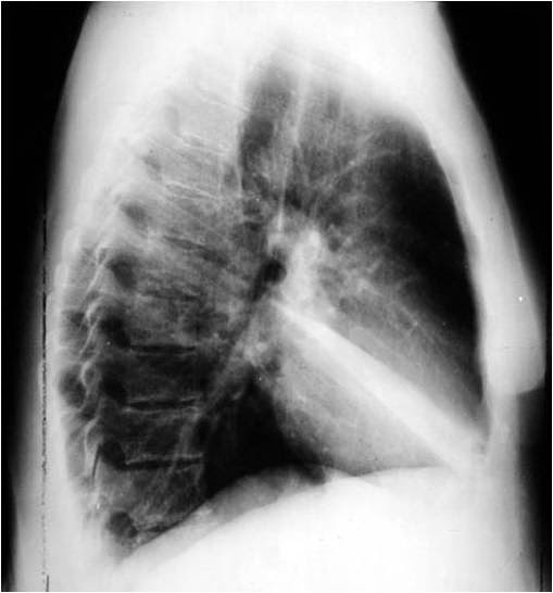 RADIOLOGY IMAGE SPOTTERS: Right middle lobe collapse