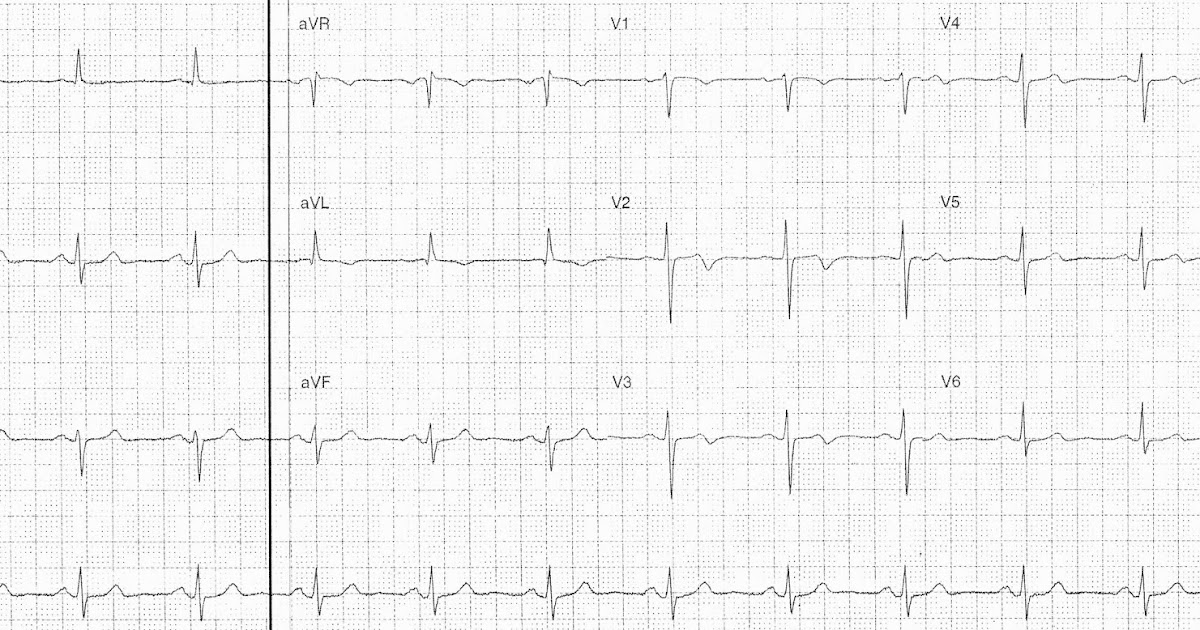 ECG of the Week: ECG of the Week - 3rd July 2017 - Interpretation