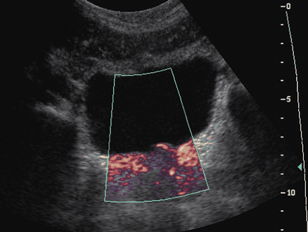 Abdominal Section: Twinkle artifact and bladder calcification