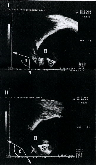Ultrasound modalities for assessment female lower urinary tract and ...