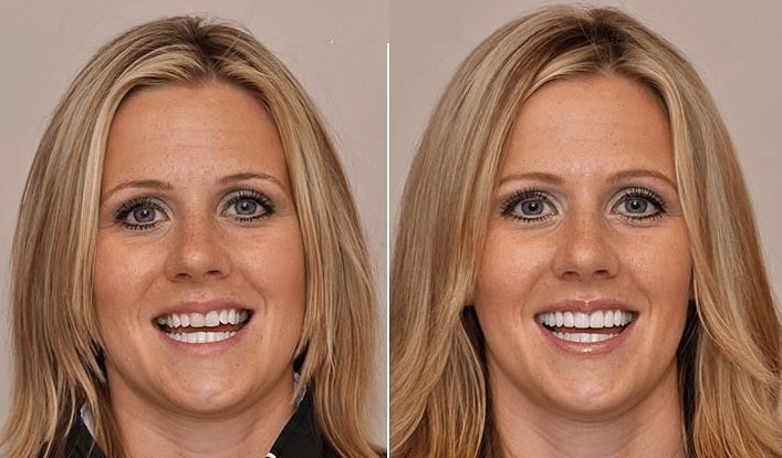 MedFriendly Medical Blog: Get a confident smile with bite correction ...