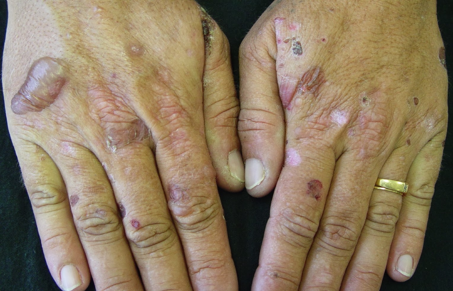 ND Clinical Board Review: Porphyria