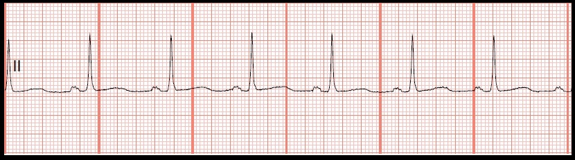 Characteristics of Sinus Rhythms
