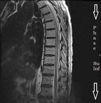 El Baúl Radiológico: ARTEFACTOS EN EL SENTIDO DE LA CODIFICACIÓN POR LA ...