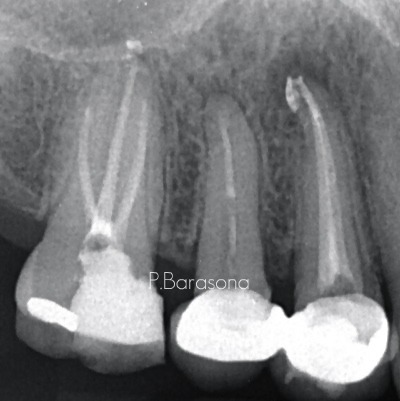 RETRATAMIENTO COMPLEJO