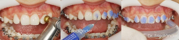 Mis brackets :D: Colocacion de brackets y Extraccion de muelas del juicio