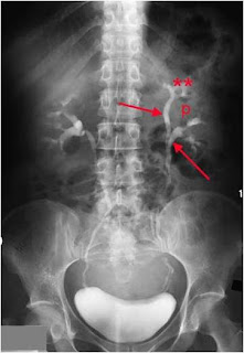 Abdominal Section: Duplicated collecting system