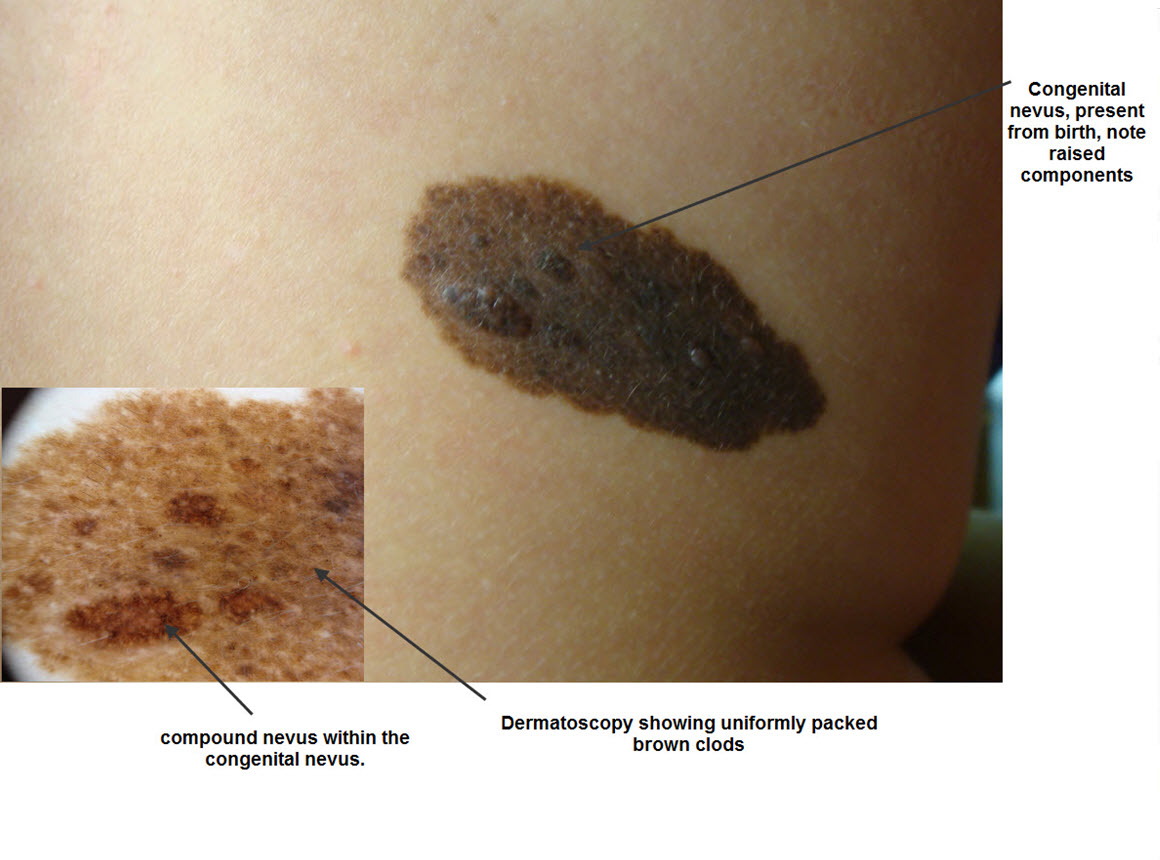 Dermpath Made Simple - Neoplastic: Benign Nevi