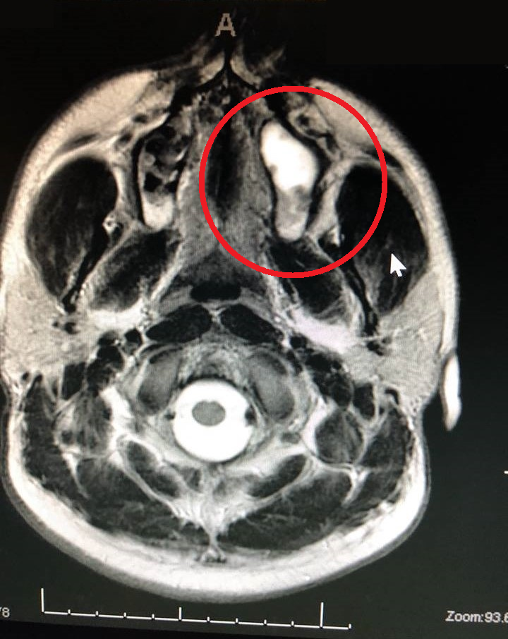 Maxillary Retention Cysts