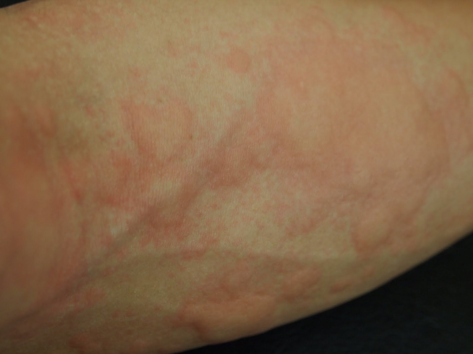 Locky's English Playground: Medical & Vocabulary: "Hives" & Allergy