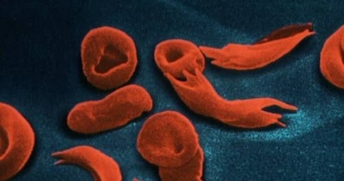 C'est quoi La Drépanocytose
