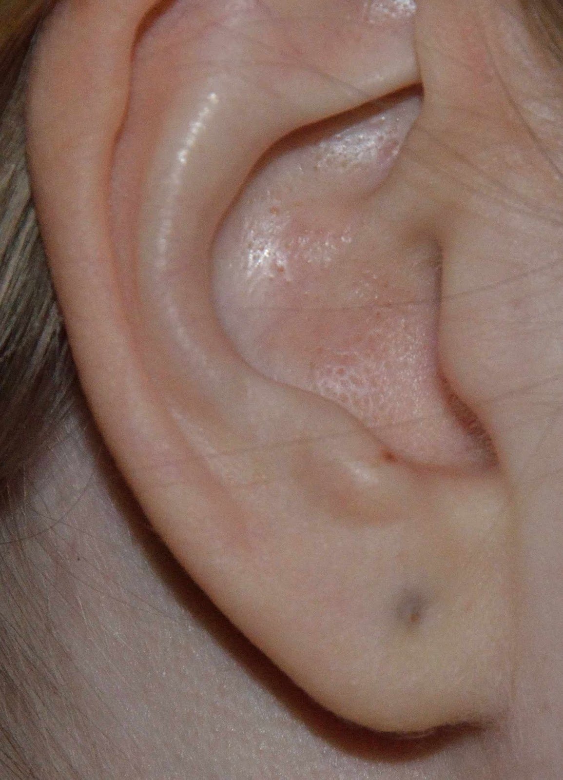 Things that make me go aagghh!: Getting rid of argyria (silver staining ...