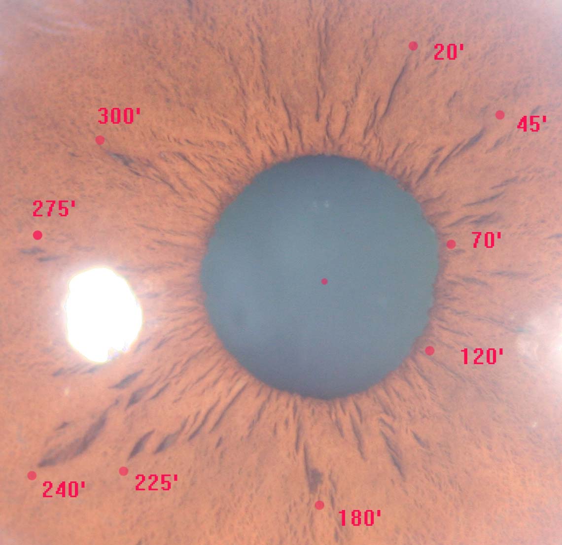 Modern & Multidimensional Iridology: Solitary Pigment, Indented Lacuna ...