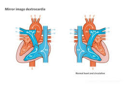 .: Dextrocardia: síndrome del corazón al revés.