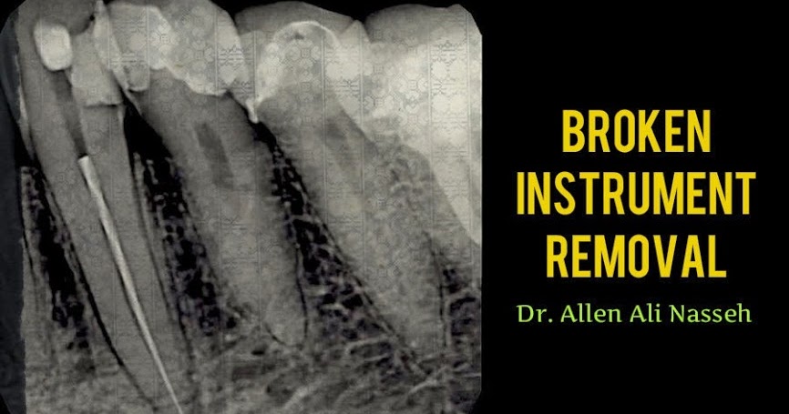 ENDODONTIC: Broken Instrument Removal - Clinical Case of Dr. Allen Ali ...