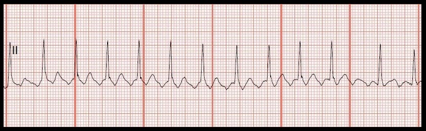 EKG Rhythm Strip Quiz 195