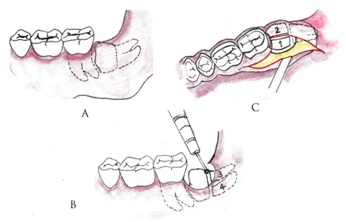 KEDOKTERAN - KEDOKTERAN GIGI: ODONTEKTOMI M3 RAHANG BAWAH