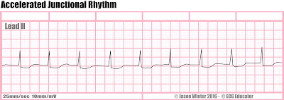 ECG Educator Blog : Accelerated Junctional Rhythm