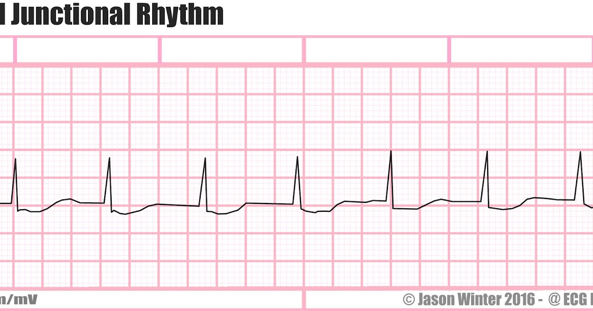 ECG Educator Blog : Accelerated Junctional Rhythm