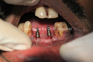 DR Murugavel's dental implant course: Replacement Of Missing Lower ...