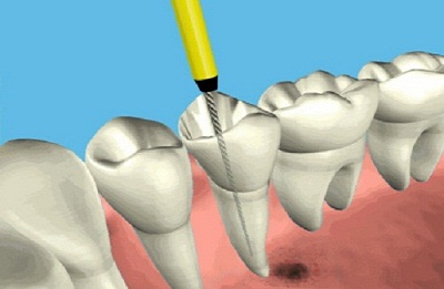 teeth extractions: Root Canal for Kids