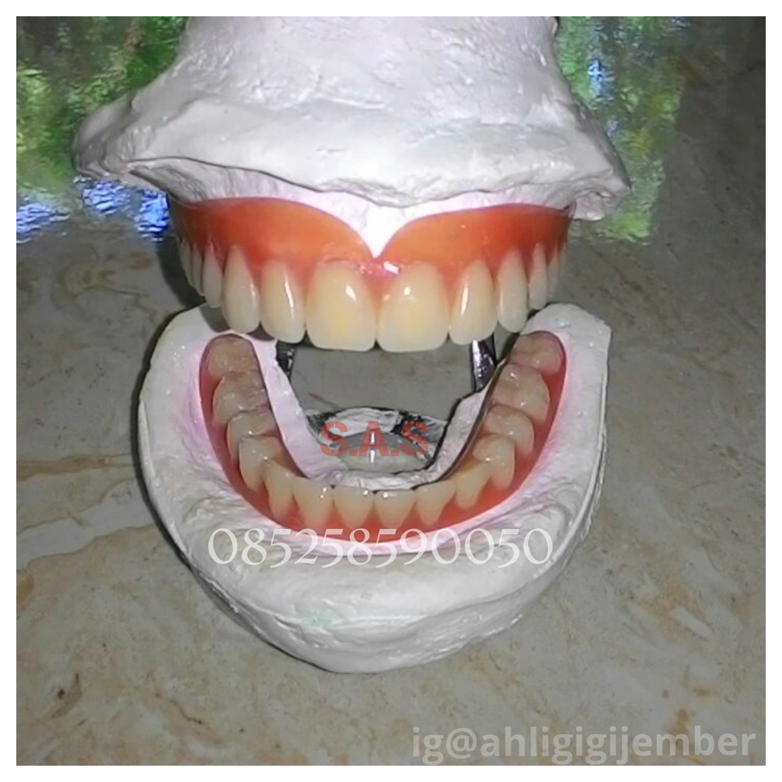Foto dan Contoh Pemasangan / Pemakaian Gigi Tiruan Lepasan Lepas Pasang ...