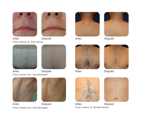 Wanita Bermisai ? Kaki Berbulu ? Bulu Roma Panjang, Banyak ? Di sini ...