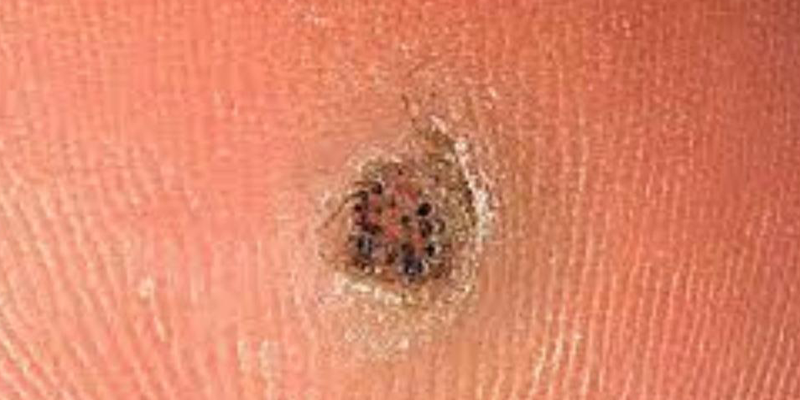 Photos of Plantar Warts ~ How To Remove Moles, Warts, Skin Tags Safely