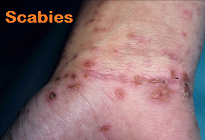 Obati Scabies dengan Cara Ampuh Sampai Sembuh! - IyenBlog.com