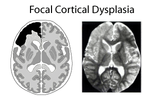 FendiHanafi: Focal Cortical Dysplasia (FCD)