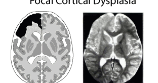 FendiHanafi: Focal Cortical Dysplasia (FCD)