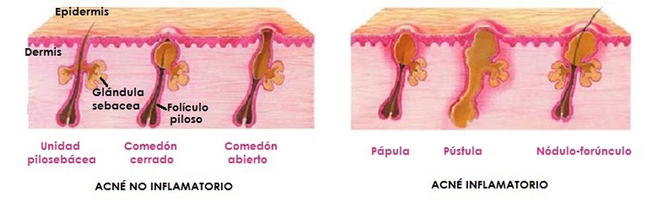 COMPRENDIENDO EL ACNÉ