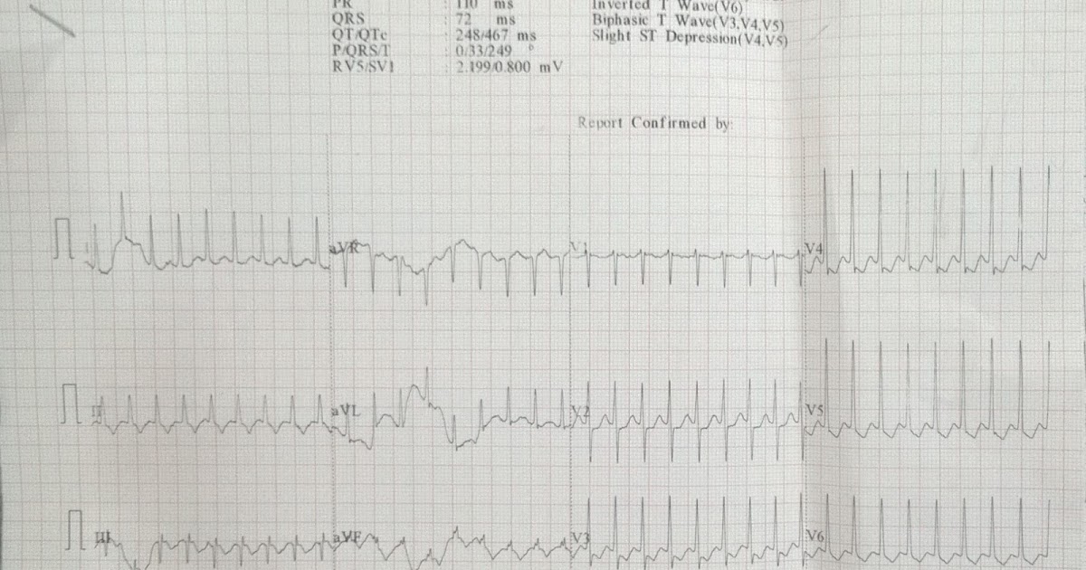 Cardiology window: ECG WPW syndrome