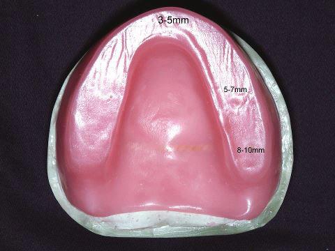 Rx Pics: Occlusal rims