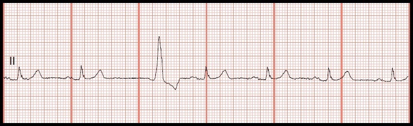 Practice EKG Rhythm Strips 144: Various Escape Beats