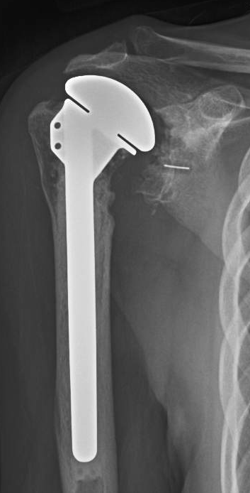 Shoulder Arthritis / Rotator Cuff Tears / Shoulder Pain : Rocking horse ...