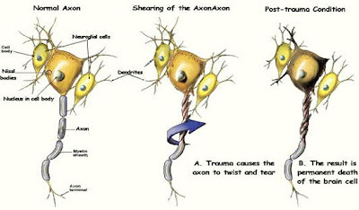 DIFFUSE AXONAL INJURY/ KERUSAKAN AXON DIFUS