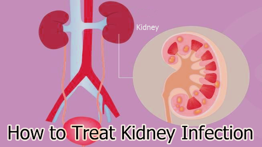 How to Treat Kidney Infection