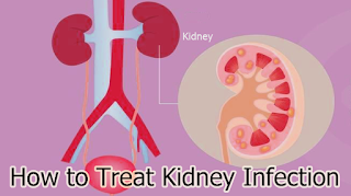 How to Treat Kidney Infection