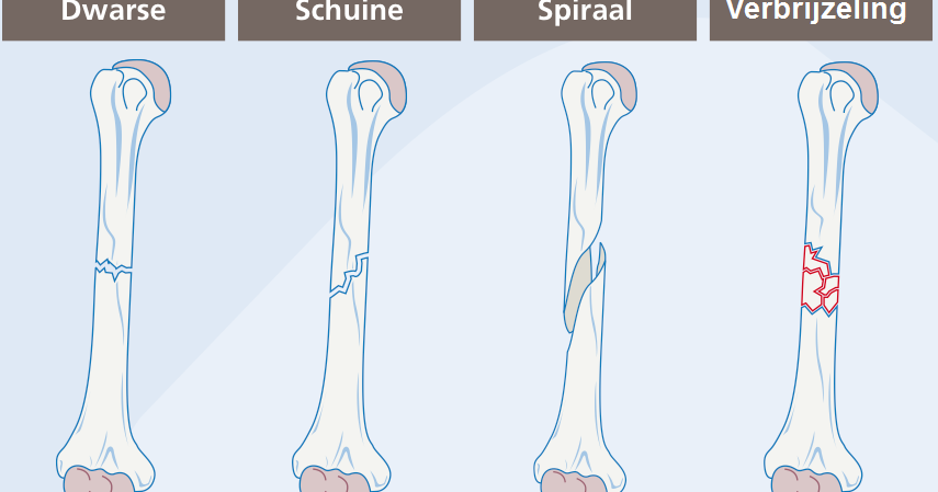 Auxilium CBD olie: CBD helpt sneller herstel bij botbreuken