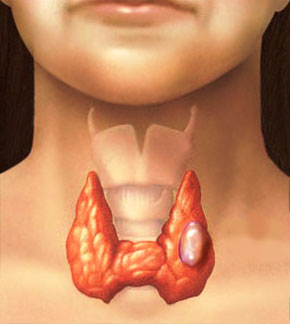 Kanker Tiroid: Jenis, Penyebab, dan Pengobatan | Medkes