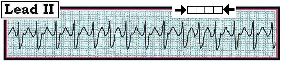 ECG Interpretation: ECG Interpretation Review - #24 (Wide Tachycardia ...