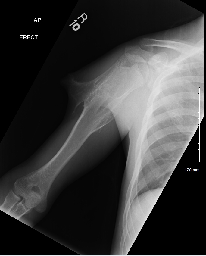 Young Adult with Multiple Hereditary Exostoses | Congenital Hand and ...