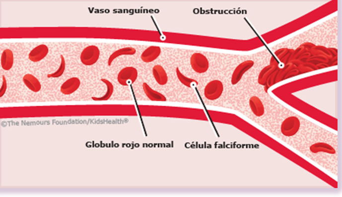 Anemia Falciforme: Célula falciforme