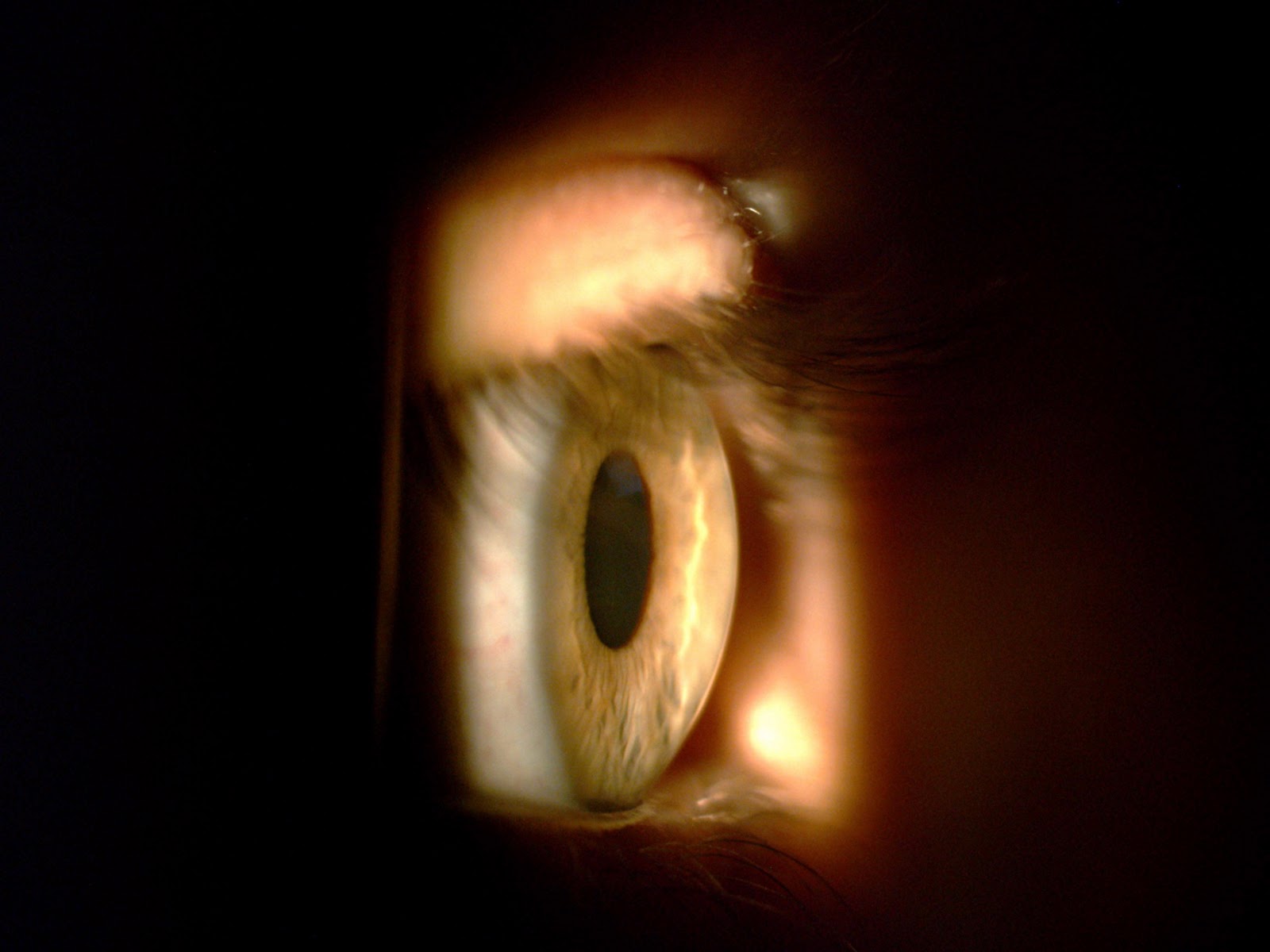 Vernon's Vision: CORNEA AND CONTACT LENS PICTURES