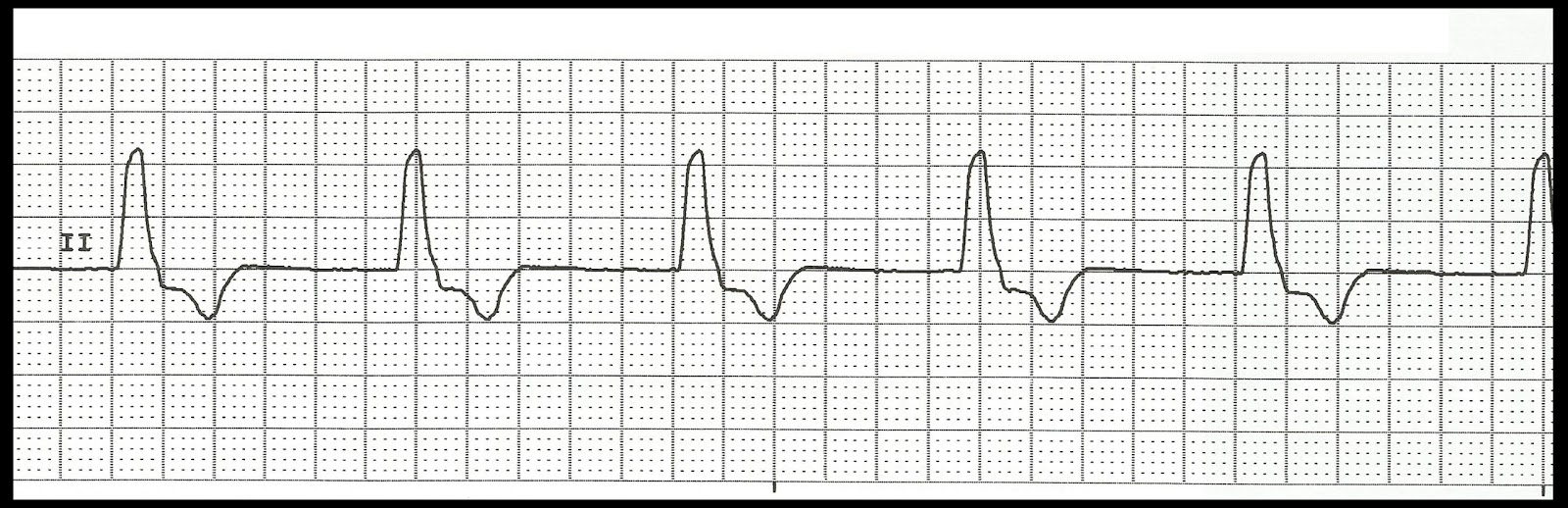 ECG Rhythm Strip Quiz 97: Ventricular Rhythms