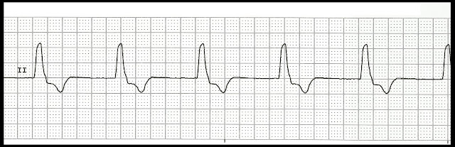 ECG Rhythm Strip Quiz 97: Ventricular Rhythms