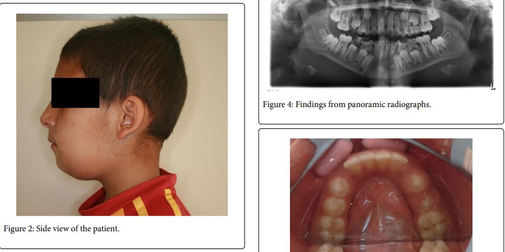 Ludwig’s Angina: A Case Report - odontobebe